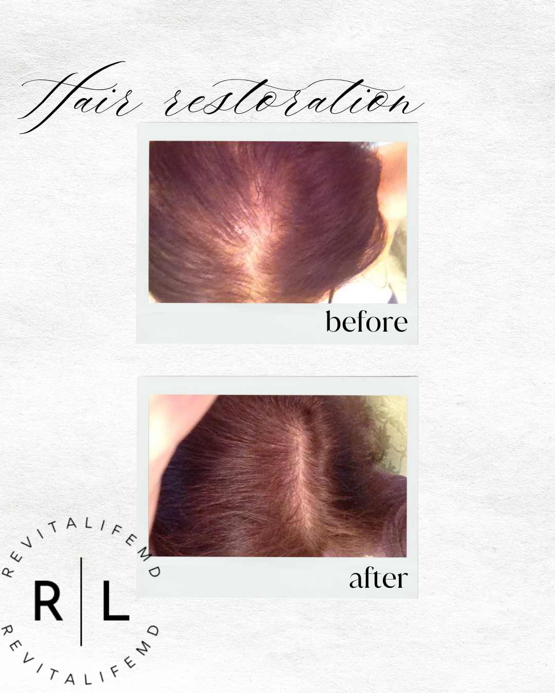 Hair Restoration Louisville, KY | Advanced Regrowth Solutions ...